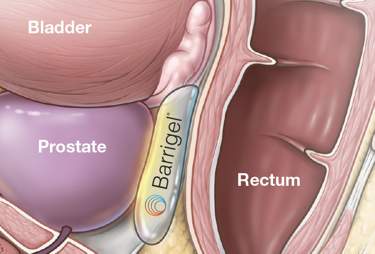 rectal spacer