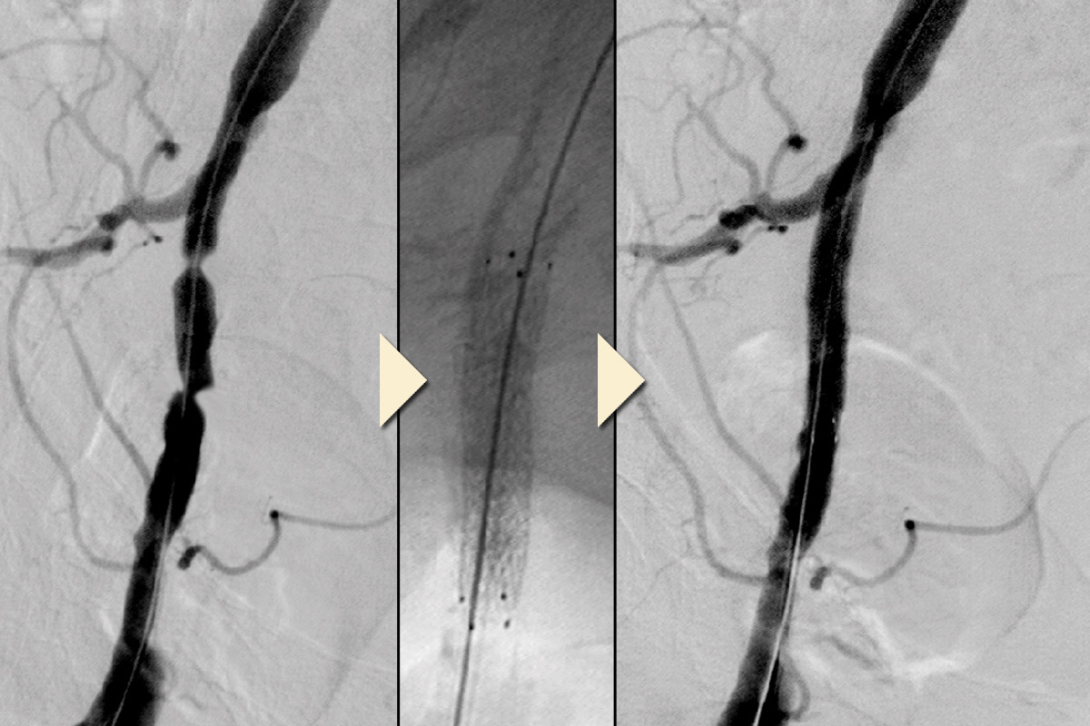 sinus-SuperFlex-635 | Duomed