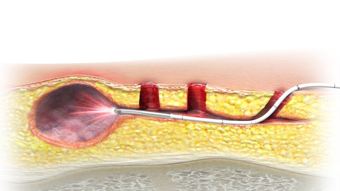 Laserablatie van de Sinus Cyste - SiLaC® | Duomed